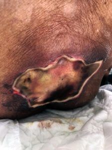Escarre stade 4 : photo, sacrum, fessier, talon traitement et prevention