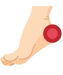 Escarre stade 4 : photo, sacrum, fessier, talon traitement et prevention