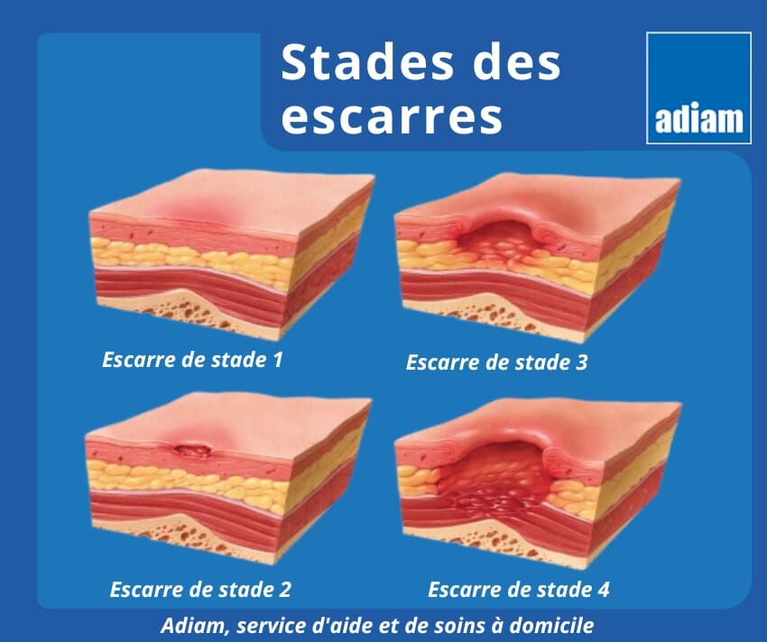 Escarre stade 4 : photo, sacrum, fessier, talon traitement et prevention